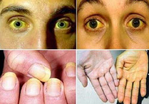 Obat Hepatitis Herbal Hepatosip - My Blog